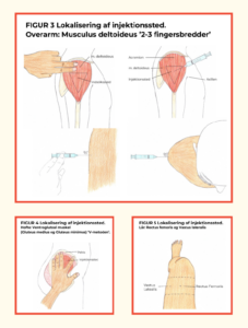 Intramuskulære injektionsteknikker -Sikker og evidensbaseret praksis i ...