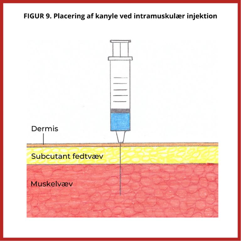 Intramuskulære injektionsteknikker -Sikker og evidensbaseret praksis i ...