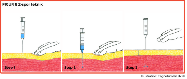Intramuskulære injektionsteknikker – en statusartikel (II ...